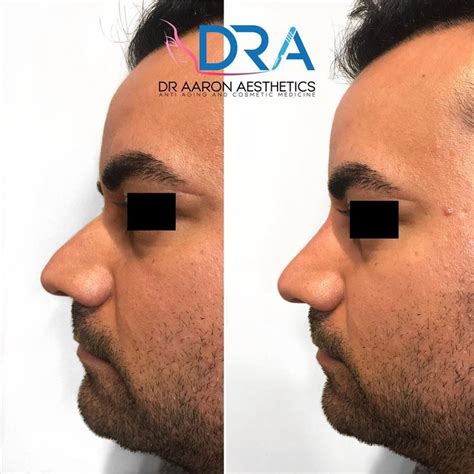 Non Surgical Rhinoplasty Purpose To Hide Bumps Straighten Your Nose