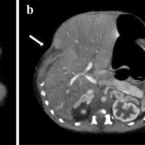 Patient 2 Ct Angiography In A 3 Day Old Girl With Ectopia Cordis And