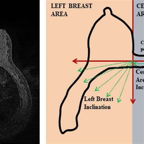 Identification Of Pectoral Muscle Area Using A Morphological Operation Download Scientific