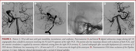 Figure 1 From Endovascular Treatment Of Posterior Cerebral Artery Aneurysms With Flow Diversion