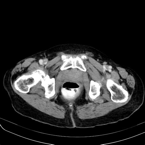 File Small Bowel Volvulus Causing Small Bowel Obstruction Mimicking Intussusception