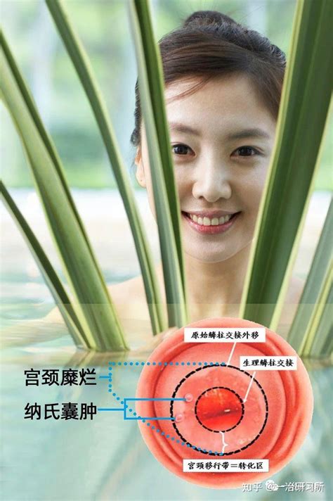 纳氏囊肿遇到炎症 妥妥的自寻烦恼 知乎