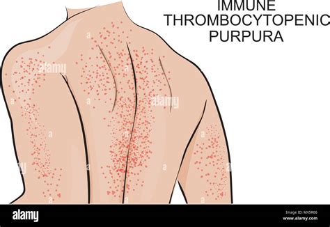 Idiopathic Thrombocytopenic Purpura Diagram