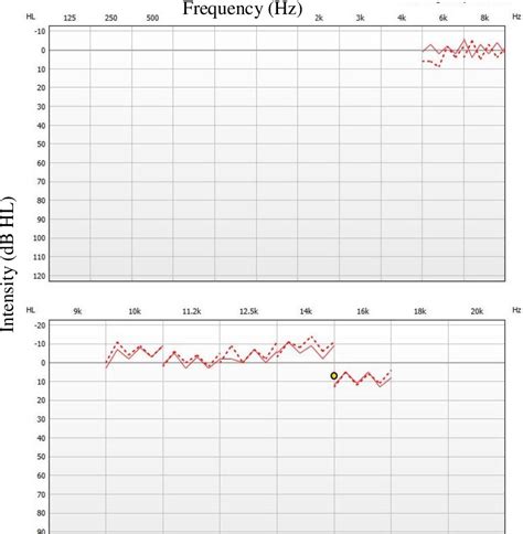 Figure 3 From Extended High Frequency Békésy Audiometry Semantic Scholar