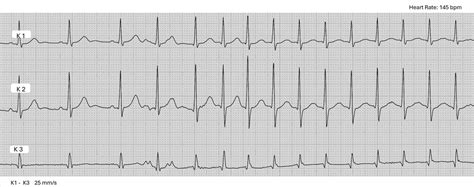Supraventricular Tachycardia Ecg Guru Instructor Resources
