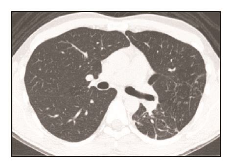 Computed Tomography Findings In TB Axial View A And Coronal