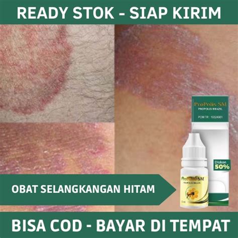 Jual Obat Gatal Selangkangan Obat Gatal Selangkangan Hitam Dan Gatal