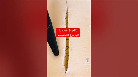خياطة الجروح التجميلية Youtube
