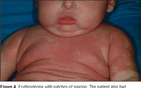 Figure 4 From X Linked Ectodermal Dysplasia With Immunodeficiency