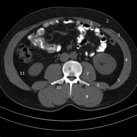 Compartment Of BMI And L3 SMI Presence Of Sarcopenia In Patients With