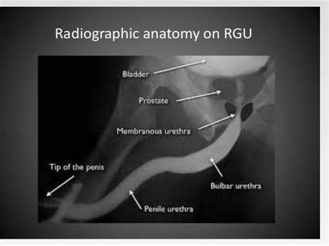 Urethral Stricturepptx