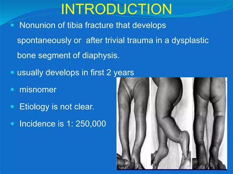 Congenital Pseudoarthrosis Of Tibia Pptx