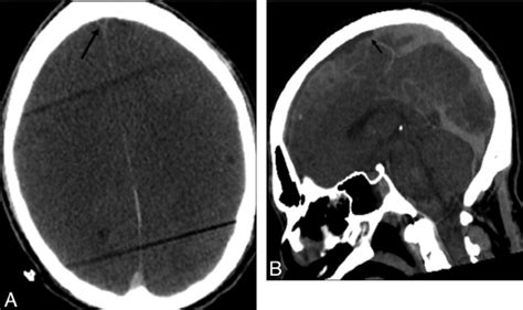 Hematocrit Effect A Axial Noncontrast Ct Reveals High Attenuation