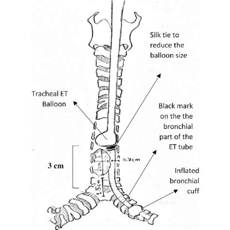 A Modified Double Lumen Tube Dlt Size 32 F The Distal End Of The Download Scientific Diagram