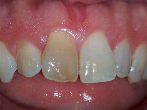 Endodontic Bleaching At Sarah Fox Blog