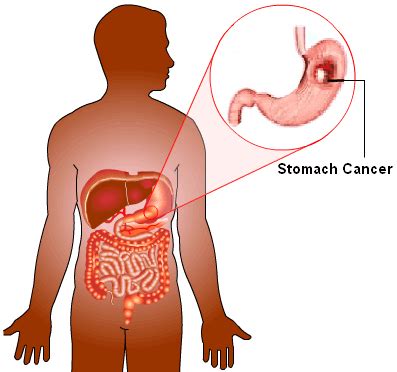 Stomach Cancer Treatment Aastha Oncology Associates