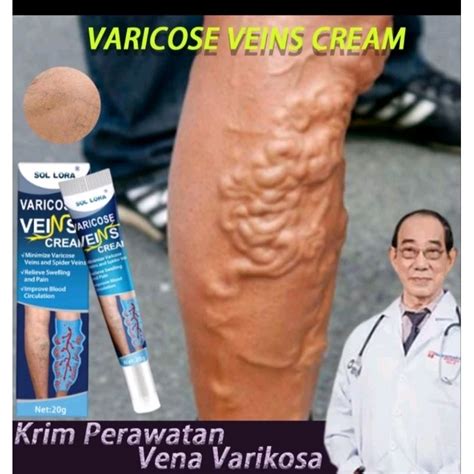 Jual Varises Cream Premium Sol Lora Herbal Salep Varicose Vein Ampuh