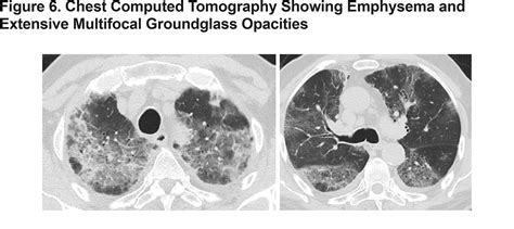 Copd Ct Scan Findings