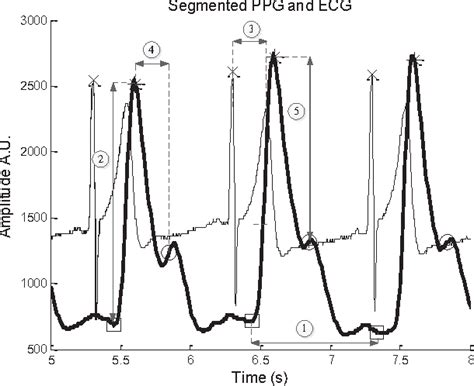 Figure 1 From An Automatic Method For Motion Artifacts Detection In