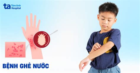 Bệnh ghẻ là gì Nguyên nhân do đâu dấu hiệu nhận biết cụ thể