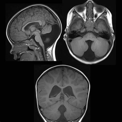 Dandy Walker Malformation Pediatric Radiology Reference Article