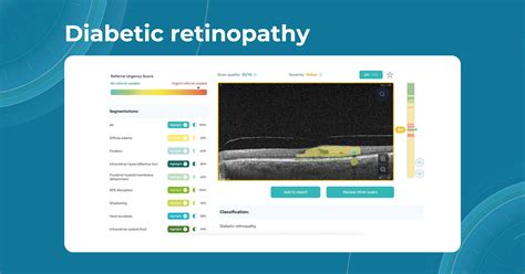 Ai Blindness Prevention How Ai Can Combat Vision Loss