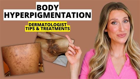 Dermatologist Explains Body Hyperpigmentation What Causes It Best