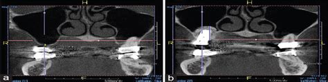 Modified Osteotome Sinus Floor Elevation Using Combination P Journal Of Indian Society Of
