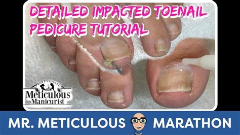 Satisfying Impacted Toenail Cleaning Pedicure Tutorial Detailed