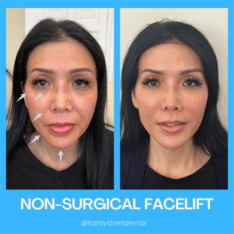 Before And After Harley Street Dermal