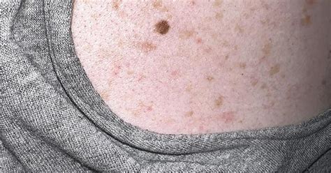 Mole Album On Imgur
