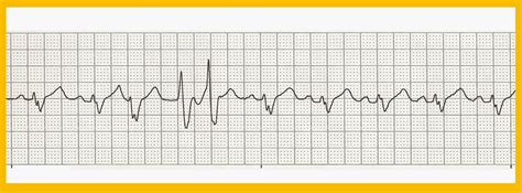Ekg Rhythm Strip Quiz 211