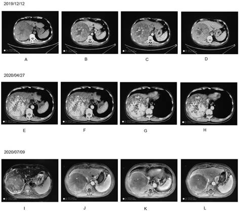 A B C D Images Of Case 2 Before PD 1 Inhibitor Therapy E F G H