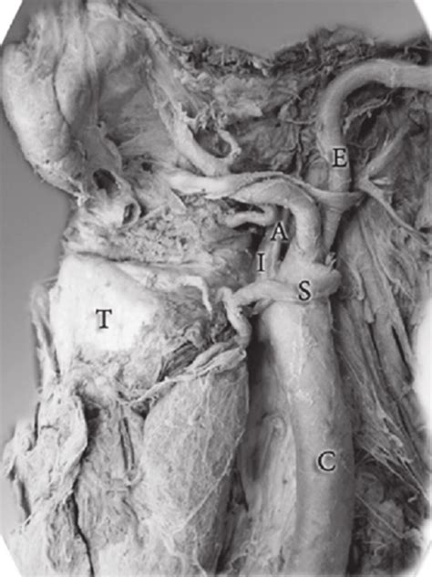 Common Carotid Artery Bifurcation