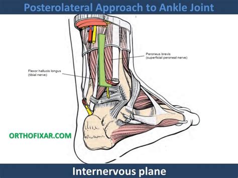 Posterolateral Approach To Ankle Joint Orthofixar 2025