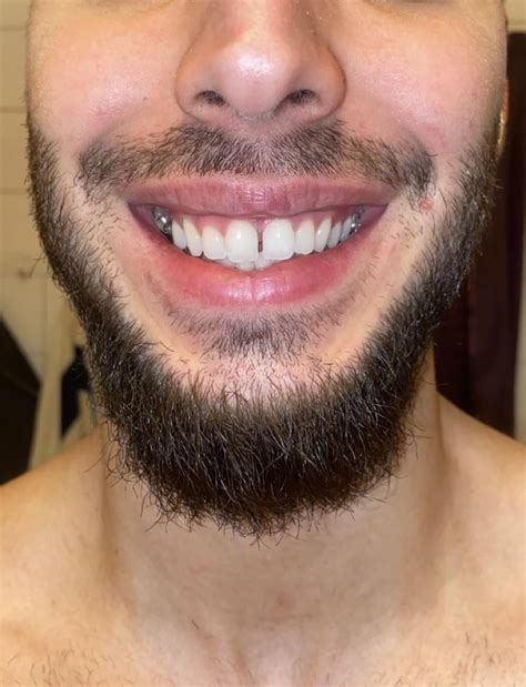 8 Screw Mse Just Split My Suture 24m My Story Rorthotropics