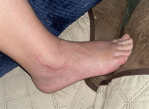 Lower Leg And Foot Discoloration 2 Months After Ankle Surgery Raskdocs
