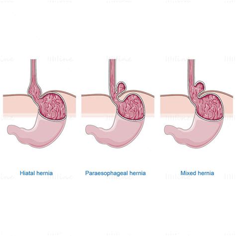 Hernia Vector Illustration