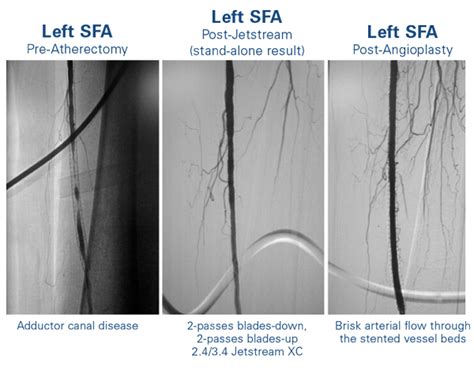 Jetstream Atherectomy System In Stent Restenosis Boston Scientific