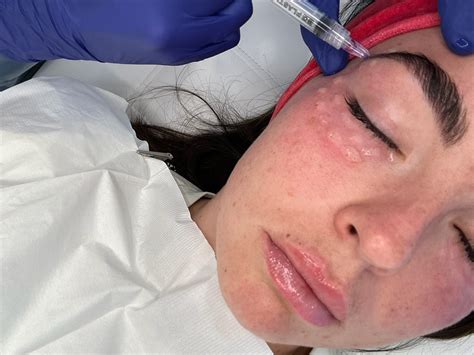 Nctf® 135ha Wrinkle Treatment In Poole And Bournemouth