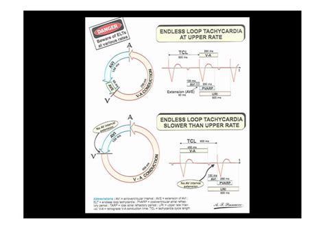 Pacemaker Mediated Tachycardia Or Not Pdf