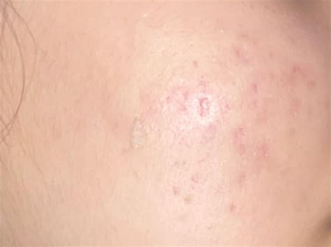 Punch Excision R Acnescars
