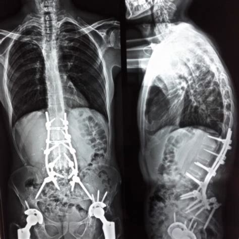 Kyphosis Treatment In Los Angeles Kyphosis Specialist