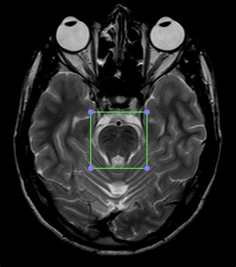Autosomal Recessive Spastic Ataxia Of Charlevoix Saguenay Nr Radiology