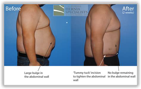 Hernia Types Umbilical California Hernia Specialists
