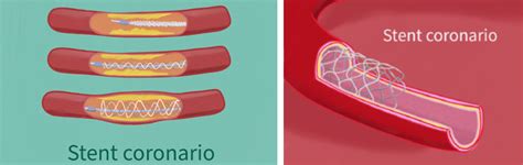 El stent coronario una solución cardiovascular Zona Hospitalaria