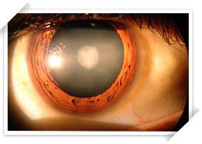 Perguntas Sobre A Cirurgia Da Catarata Dr Marcelo Vilar
