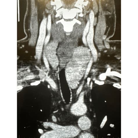Thyroid Artery Embolization Florida Interventional Specialists