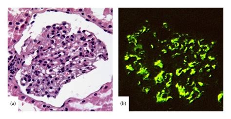 Lupus Nephritis Class Ii A Moderate Mesangial Hypercellularity In
