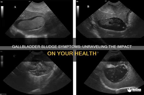 Gallbladder Sludge Symptoms Unraveling The Impact On Your Health Medshun